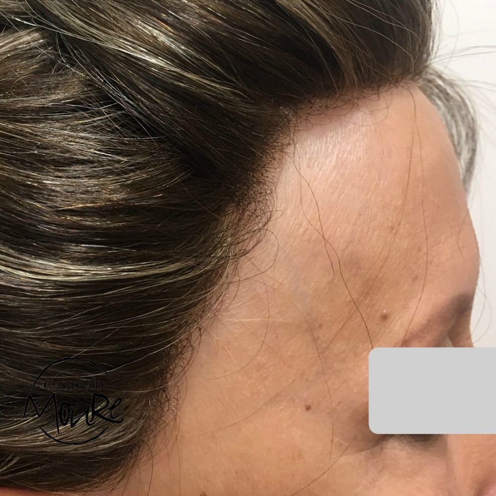 PRÓTESIS CAPILAR MALLORCA ESPECIALISTAS CENTROS MOURE